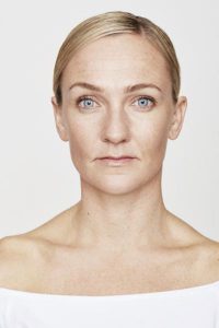 Fillers i tinningarna - Föryngrande resultat - Klinik Villastan i Borås