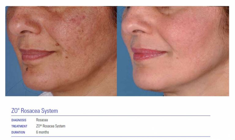 Rosacea - Behandla rosacea hos oss - Klinik Villastan i Borås