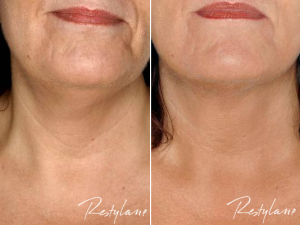 Fillers hals - Behandla rynkor på halsen - Klinik Villastan i Borås